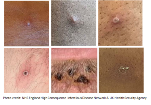 Hot Topic: Mpox - Nevada Public Health | The Office of State Epidemiology